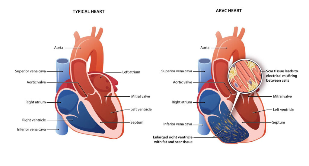 About ARVC (Arrhythmogenic Right Ventricular Cardiomyopathy) - Tenaya ...