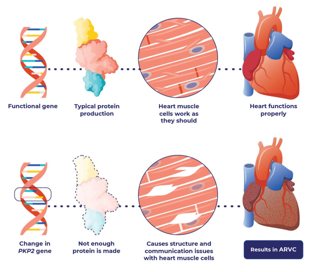 About ARVC (Arrhythmogenic Right Ventricular Cardiomyopathy) - Tenaya ...