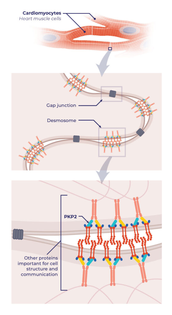 About ARVC (Arrhythmogenic Right Ventricular Cardiomyopathy) - Tenaya ...